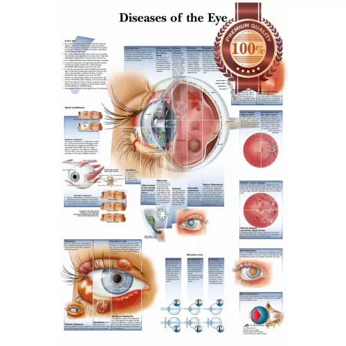 DISEASES OF THE HUMAN EYE INFOMATIONAL CHART DIAGRAM PRINT PREMIUM POSTER